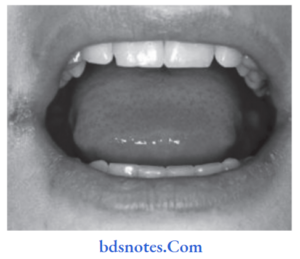 Developmental Anomalies Of The Tongue - BDS Notes
