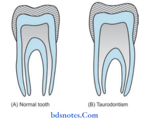 Taurodontism: Understanding the Bull-Shaped Tooth Anomaly - BDS Notes