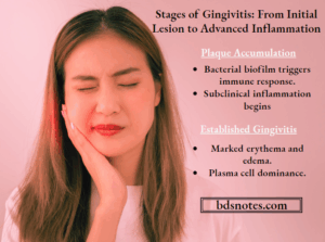 Stages of Gingivitis: From Initial Lesion to Advanced Inflammation ...