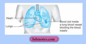 Pulmonary Embolism - BDS Notes