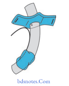 Tracheostomy: Types, Indications, Procedure, And Potential ...