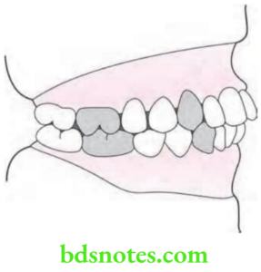 Classification Of Malocclusion Question And Answers - BDS Notes