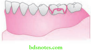 Adams Clasp Theory And Fabrication - BDS Notes