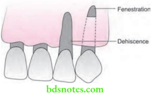 Fenestration and Dehiscence: Role in Periodontics, Diagnosis ...