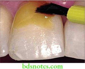 Application of Cavity Liners And Varnish Notes - BDS Notes
