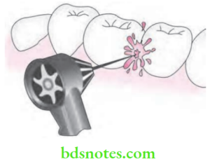 Prevention Of Periodontal Disease Question And Answers - BDS Notes