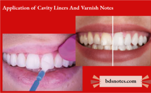 Application of Cavity Liners And Varnish Notes - BDS Notes