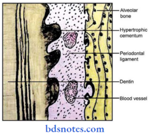 Cementum Of Tooth Question And Answers - BDS Notes