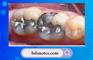 Dental Amalgam Alloys: Low Copper vs. High Copper Explained - BDS Notes