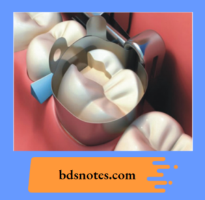 Dental Amalgam Alloys: Low Copper vs. High Copper Explained - BDS Notes