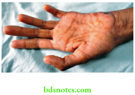 Chronic Infectious Disease Types Notes - BDS Notes