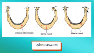 Classification of Maxillofacial Injuries Notes - BDS Notes