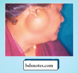 Salivary Gland Tumours Notes - BDS Notes