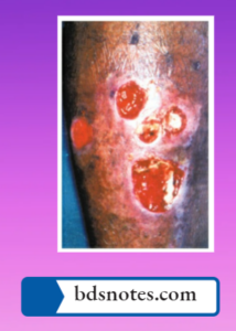 Ulcer Classification and Venous Leg Ulcer Treatment Notes - BDS Notes