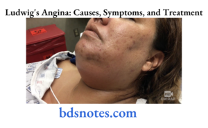 Ludwig's Angina: Causes, Symptoms, and Treatment - BDS Notes