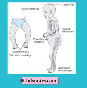 Rickets - BDS Notes