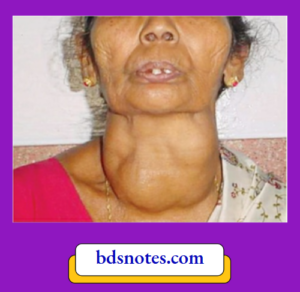 Goitre - Disease, Treatment, Thyroid Notes - BDS Notes