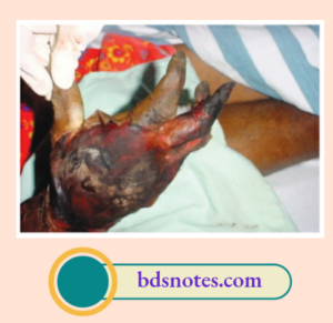 Gangrenem - Definition, Classification, Signs Notes - BDS Notes