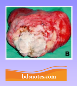 Dermoid Cyst Ovary Causes Notes - BDS Notes