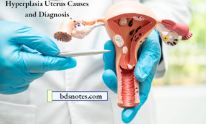 Hyperplasia Uterus Causes and Diagnosis - BDS Notes