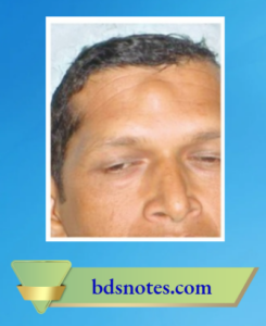 Dermoid Cyst Ovary Causes Notes - BDS Notes