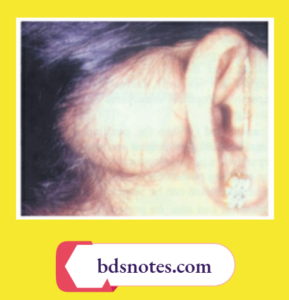 Dermoid Cyst Ovary Causes Notes - BDS Notes