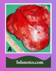 Dermoid Cyst Ovary Causes Notes - BDS Notes