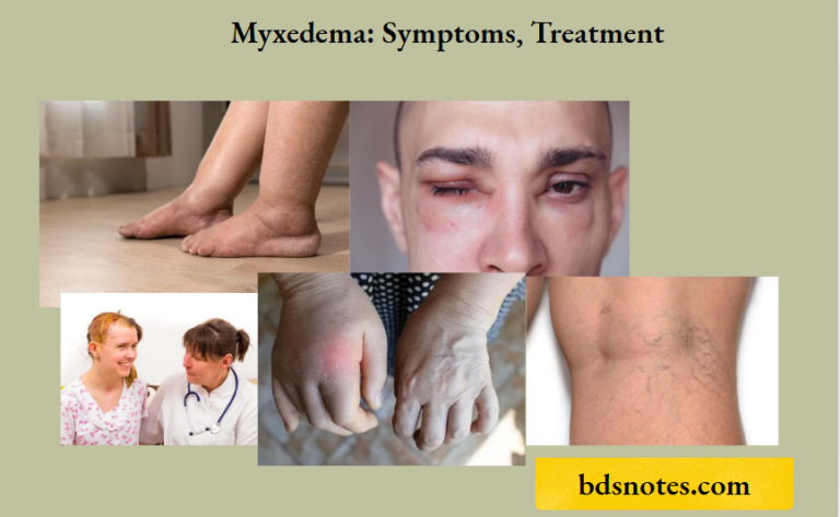 Myxedema: Symptoms, Treatment - BDS Notes
