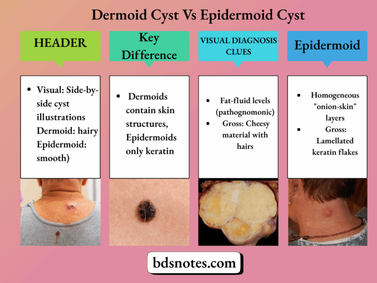 Dermoid Cyst Vs Epidermoid Cyst - BDS Notes