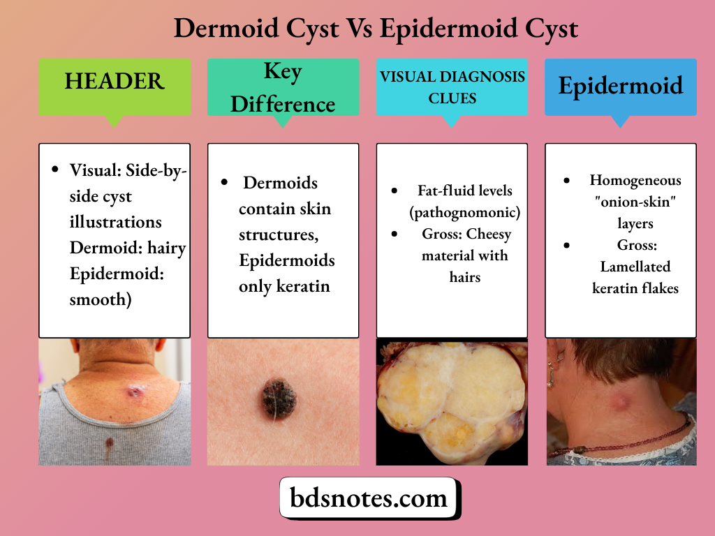 Dermoid Cyst Vs Epidermoid Cyst - BDS Notes