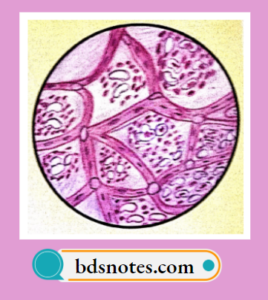Fibrosarcoma: Causes, Diagnosis, and Treatment - BDS Notes