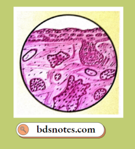 Fibrosarcoma: Causes, Diagnosis, and Treatment - BDS Notes