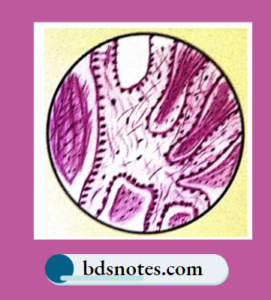 Fibrosarcoma: Causes, Diagnosis, and Treatment - BDS Notes