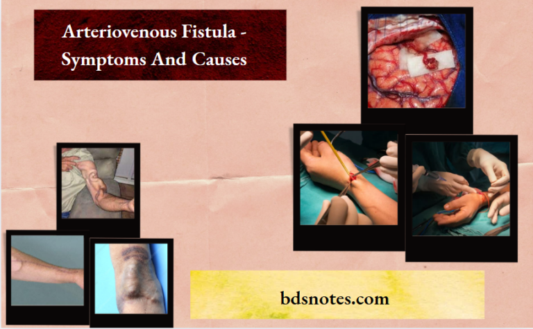 Arteriovenous Fistula - Symptoms & Causes - BDS Notes