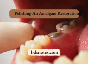 Polishing An Amalgam Restoration - BDS Notes