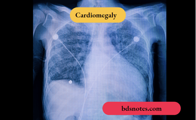 Massive Cardiomegaly: Causes and Underlying Cardiac Conditions - BDS Notes