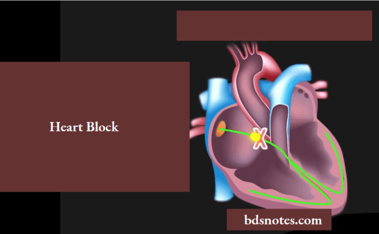 Complete Heart Block: Causes, Symptoms, ECG Findings, and Treatment ...